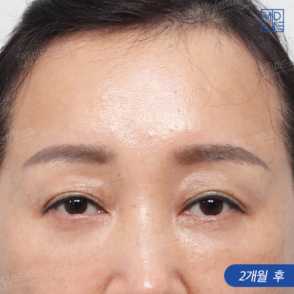 이마거상 눈밑지방재배치 눈위·눈밑지방이식 2개월 후 미드라인성형외과